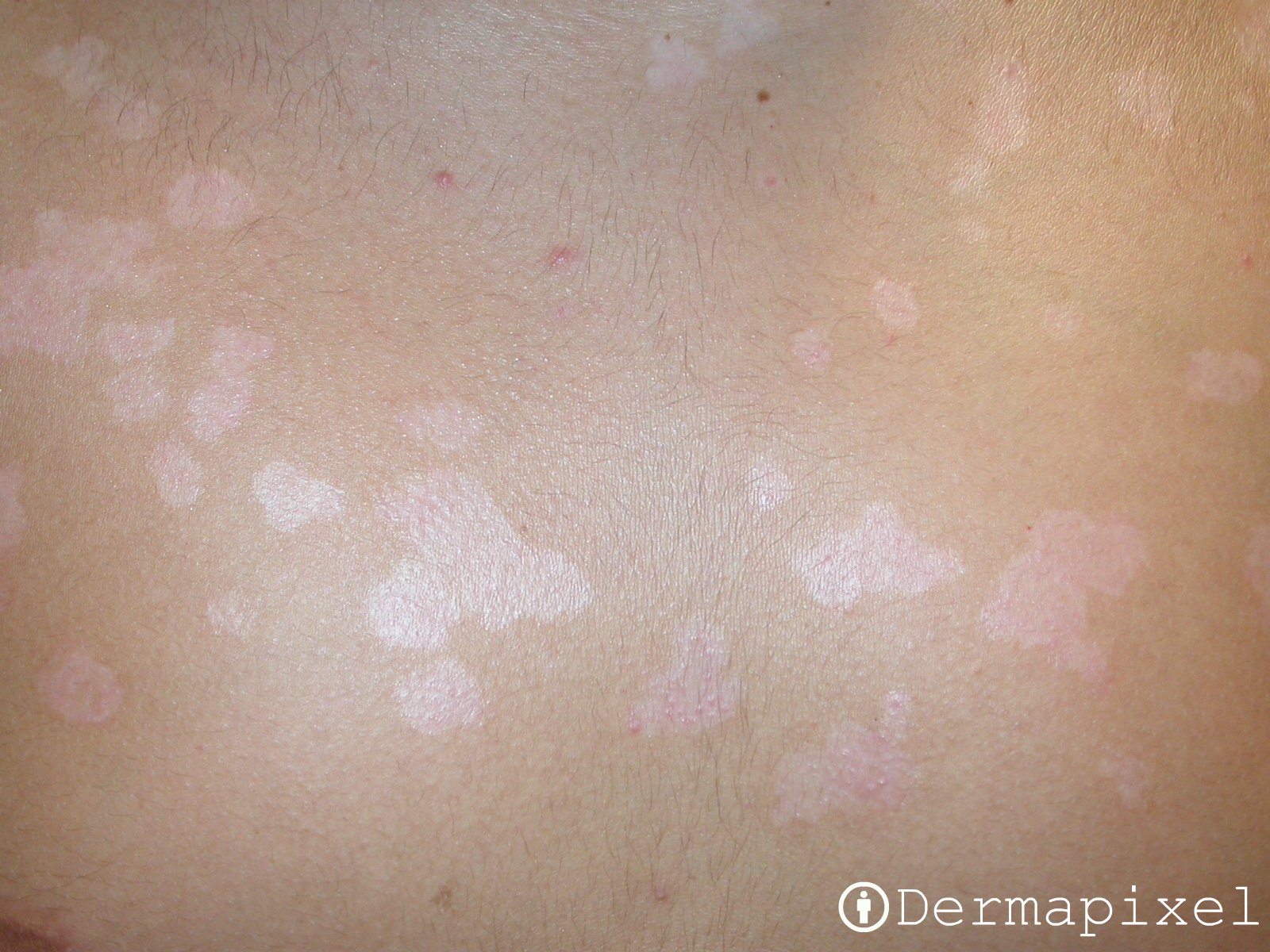 Dermapixel: No sólo de niños vive el impétigo