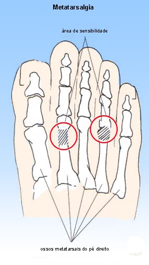 Fisioterapia Passo Fundo: METATARSALGIA