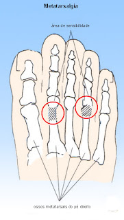 Fisioterapia Passo Fundo: METATARSALGIA