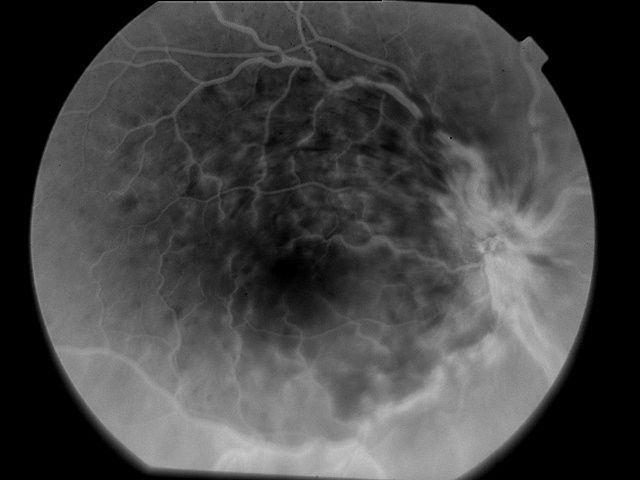 RETINACALI - OVCR (CRVO) ANGIOGRAFIA