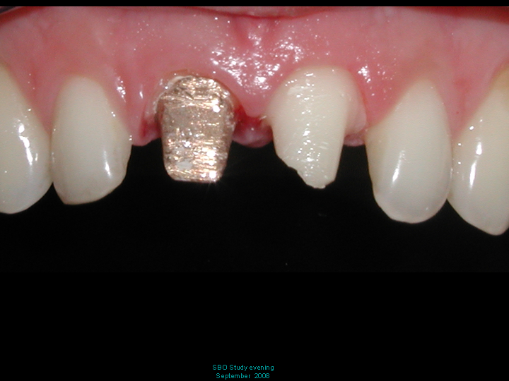SBO Dental Laboratory: March 2011