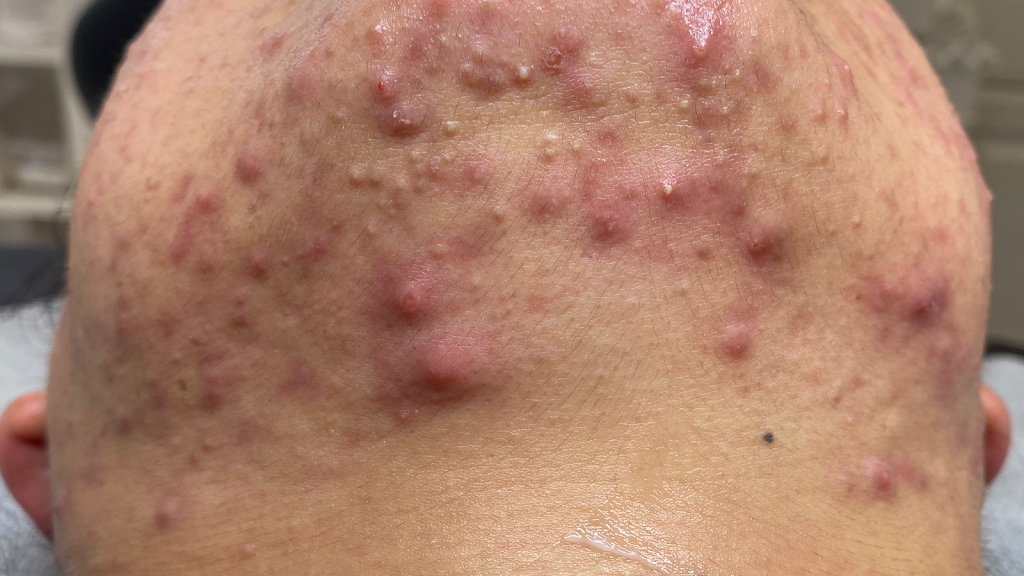 Bare Complexion Acne & Skincare - Ventura, CA 93001 - Services and Reviews