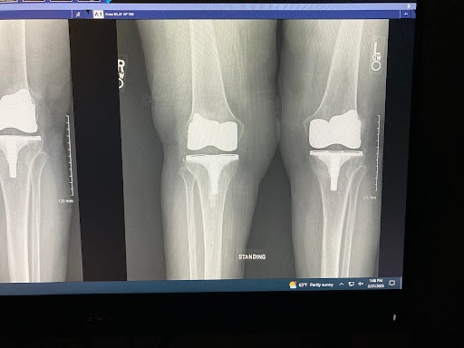 Knee Patellofemoral Pain Syndrome Diagnosis | George Gendy MD