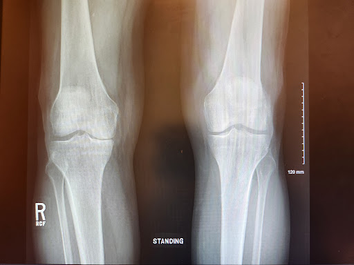 Meniscus Radial Tear | George Gendy MD