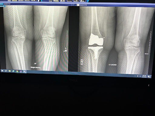 Meniscus Radial Tear | George Gendy MD