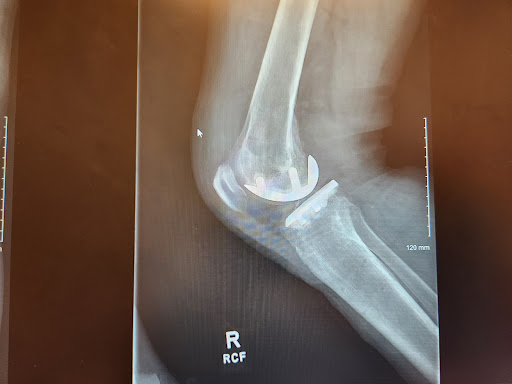 Meniscus Radial Tear | George Gendy MD