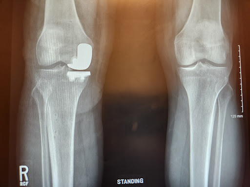 Meniscus Radial Tear | George Gendy MD