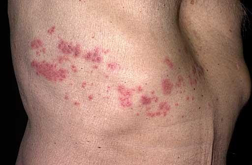 Lymphoma Rash On Legs