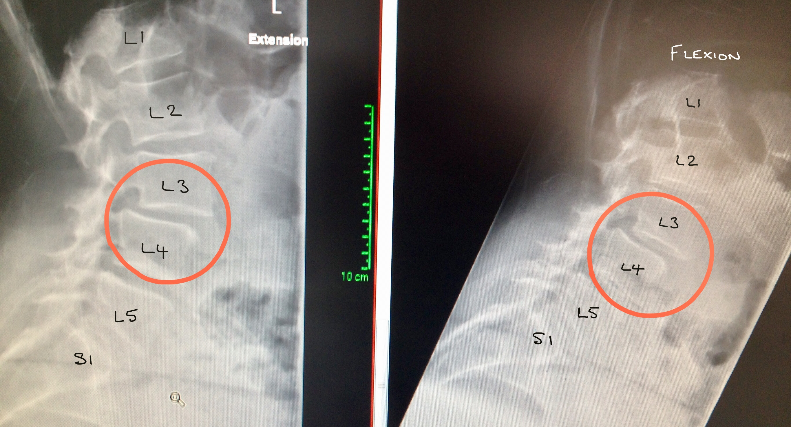 78 Amazing What Does Lateral Listhesis Mean Insectza