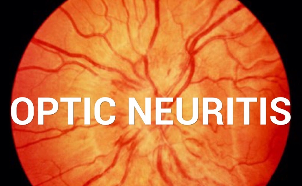 Multiple Sclerosis Research: Optic neuritis destroys retinal nerves ... Multiple Sclerosis Research: Optic neuritis destroys retinal nerves ...